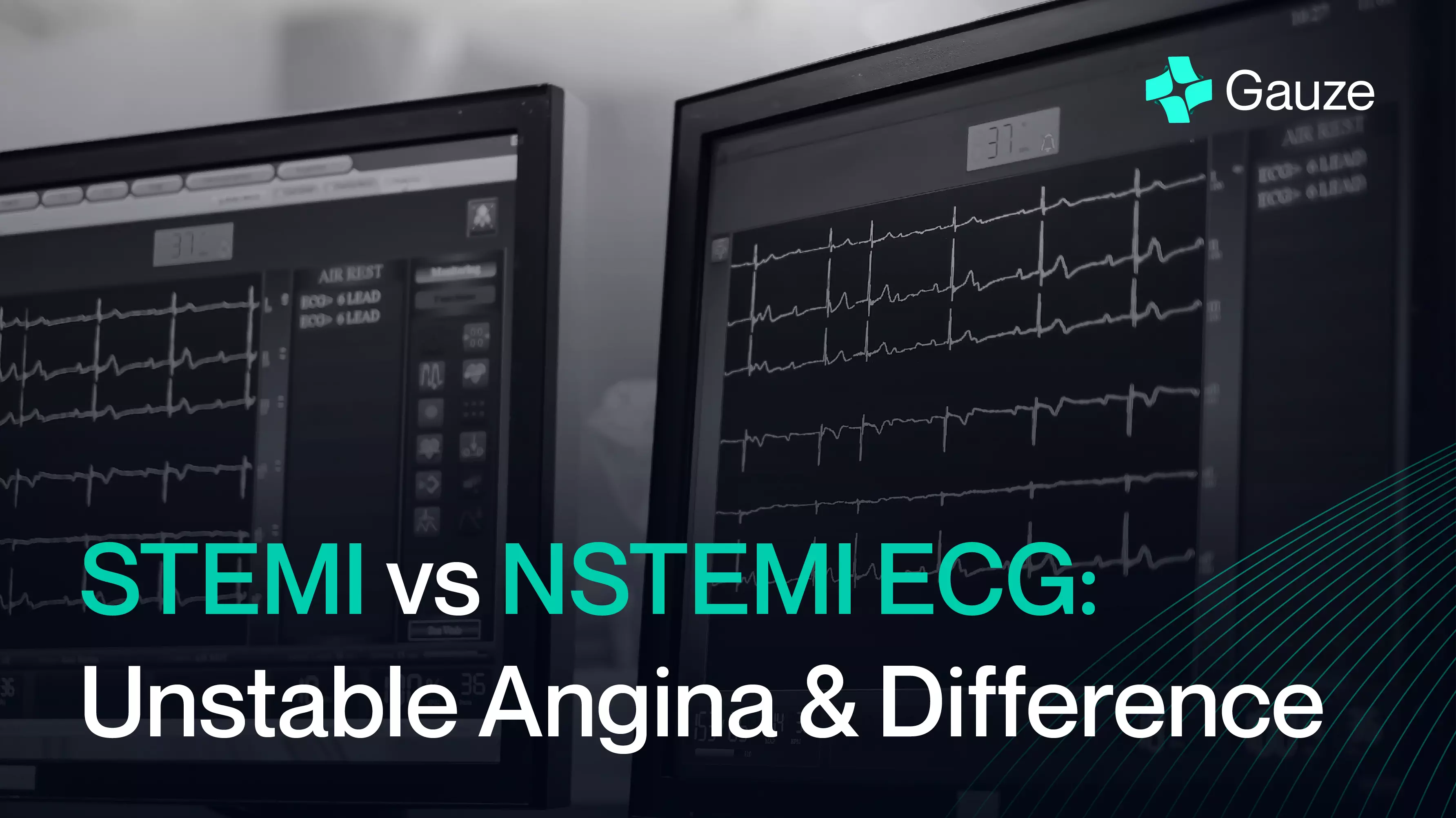 Understanding STEMI vs NSTEM ECG
